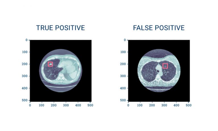 Using Medical Image Processing: AI for Lung Cancer Early Detection - Azoft